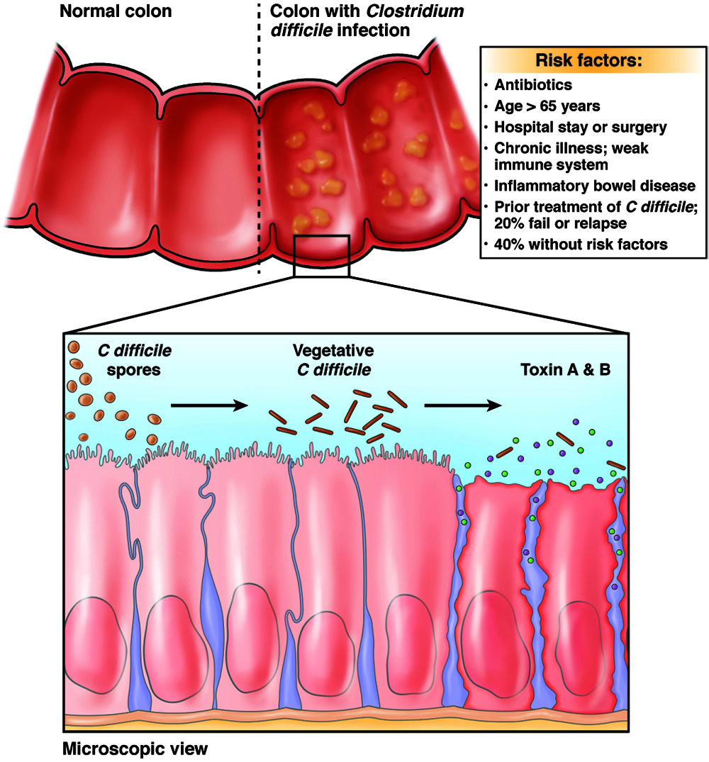 Clostridioides difficile (C. diff) - AGA GI Patient Center