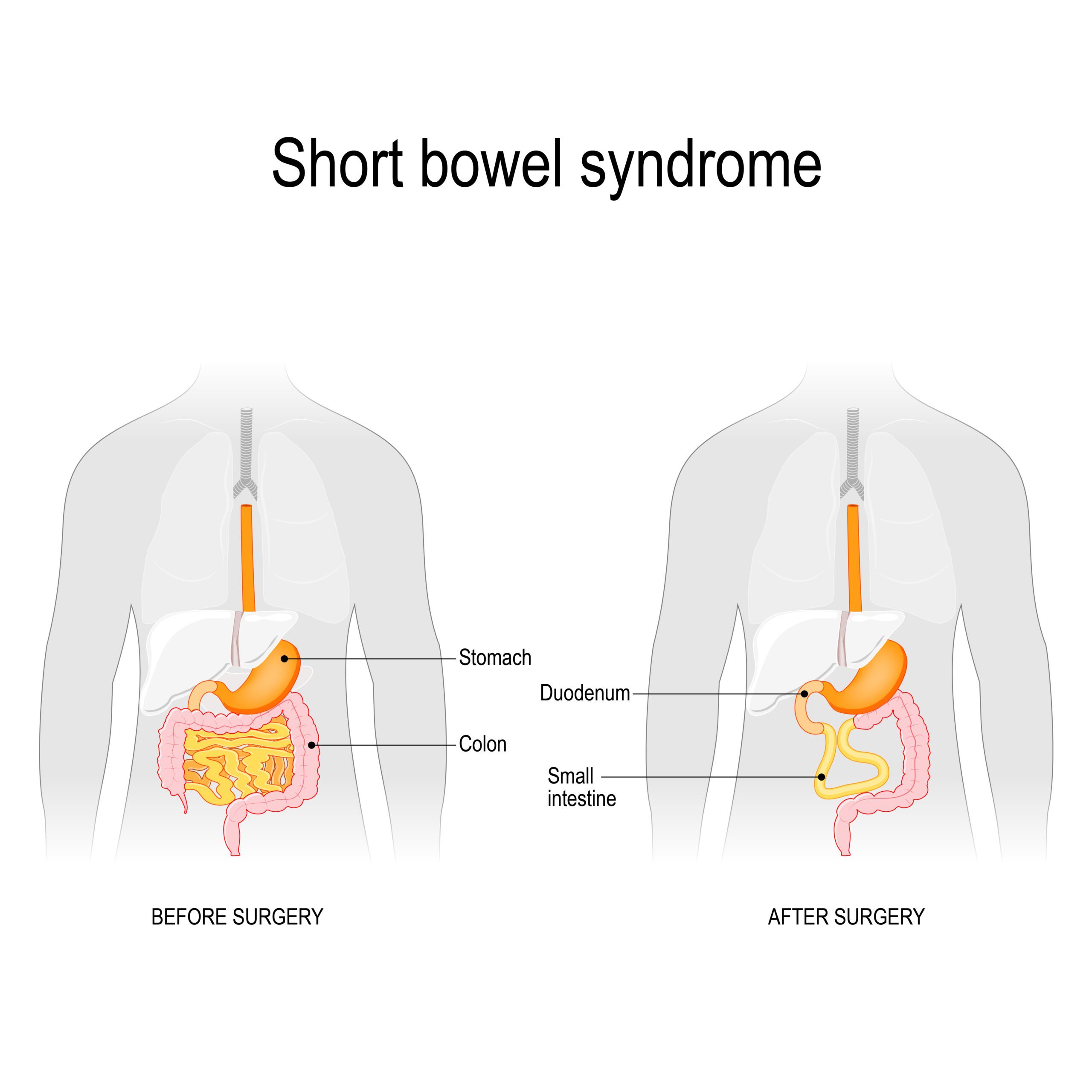 Short bowel syndrome (SBS): Colostomy diet - AGA GI Patient Center